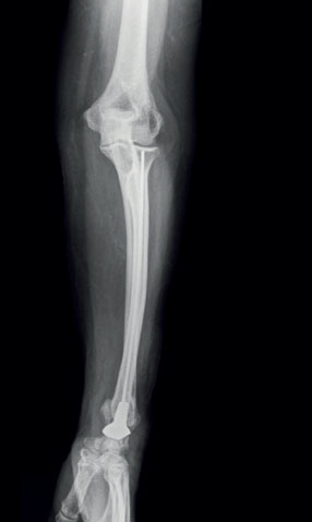 ProtheLast - argomedical.de